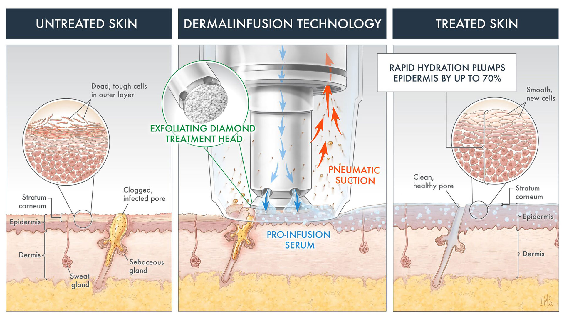 Diamond Dermal Infusion – Serente